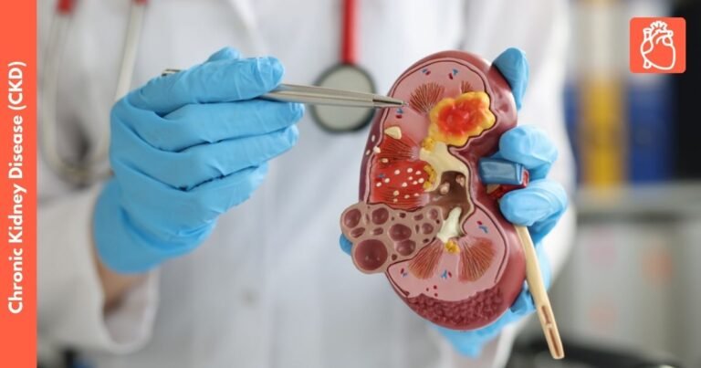 Chronic Kidney Disease (CKD): Symptoms, Causes, Treatment & Prevention ...